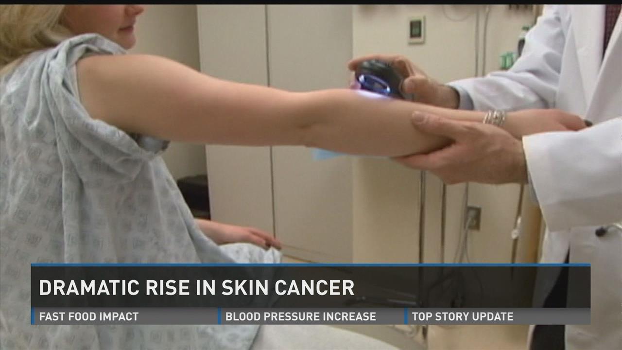 Melanoma Monday at the U of M | kare11.com